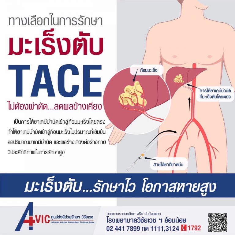 TACE ทางเลือกในการรักษามะเร็งตับ ไม่ต้องผ่าตัด ลดผลข้างเคียง